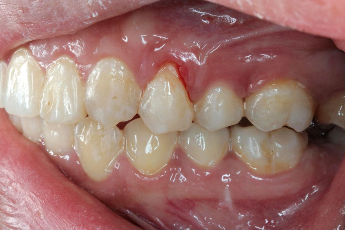 Gum Recession Causes Treatment Prevention And More Gum Recession Causes Treatment Prevention And More