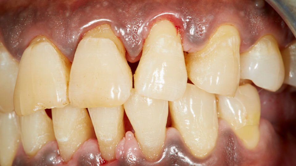 Gum Disease: Causes, Symptoms & Risk Factors