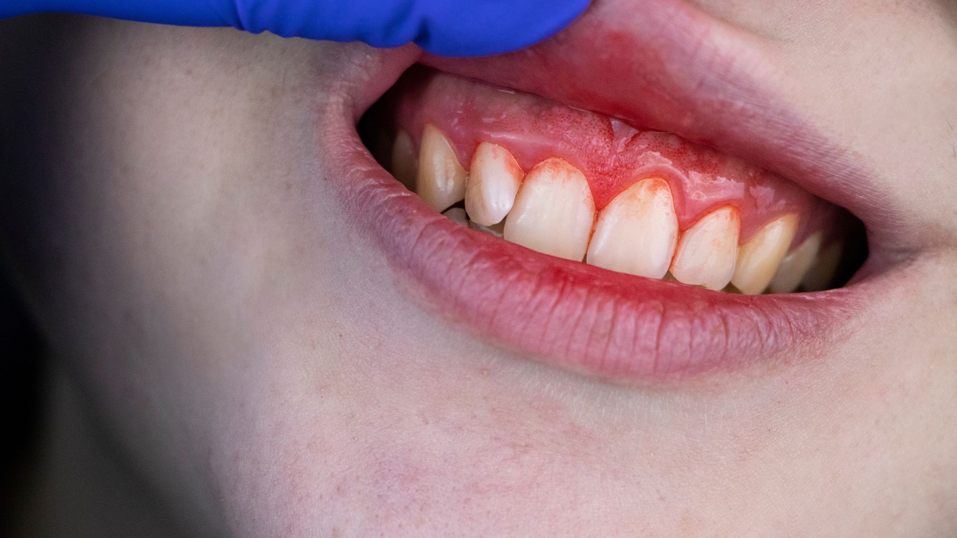 Can You Cure Gum Disease? - Can It Be Reversed?