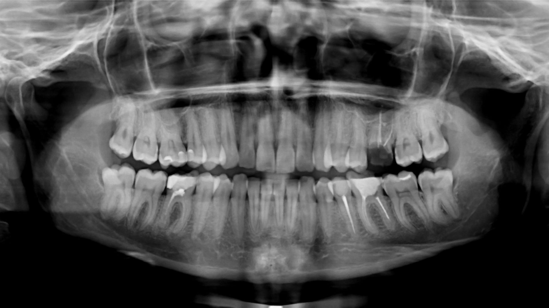 Gum Grafting for Black Triangles - Is It A Solution