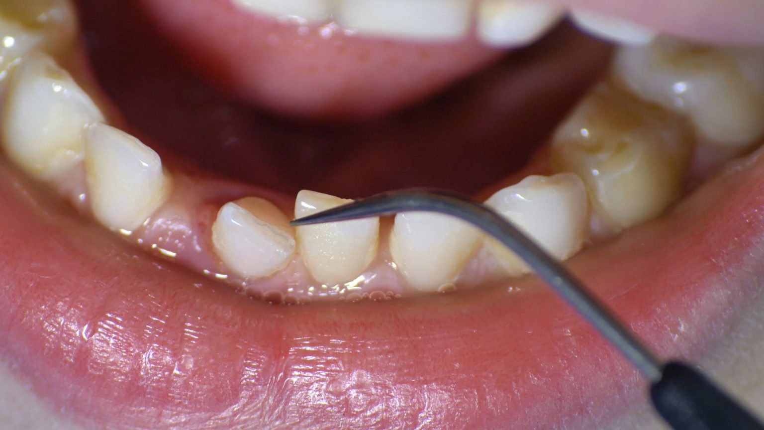 How Is Gum Recession Measured? | Gum Disease Guide