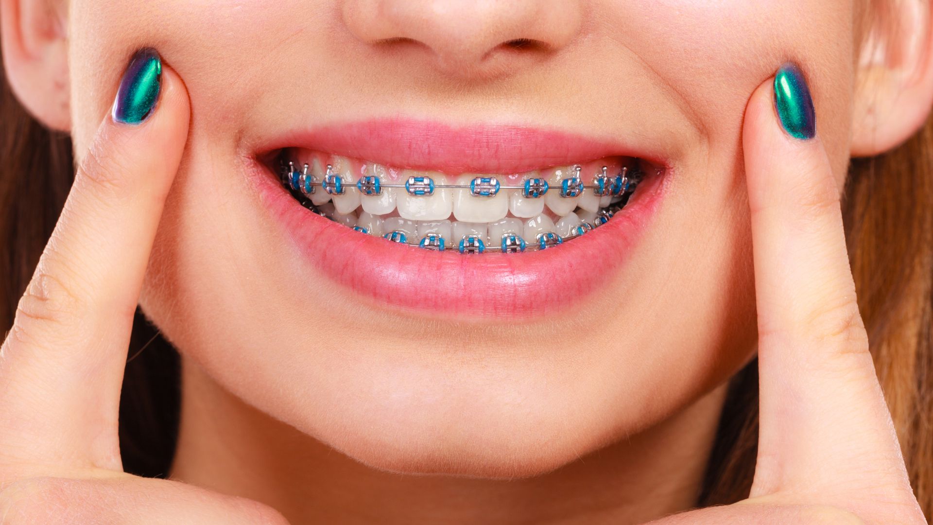 Gum Recession And Braces