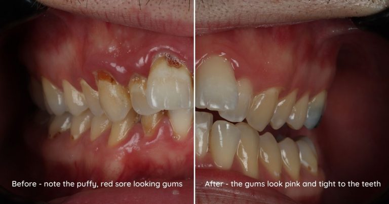 What Does Gum Disease Look Like? The Signs & Symptoms